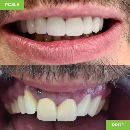 Zubi prije i posle | Stomatološka ordinacija Dr Filimanović
